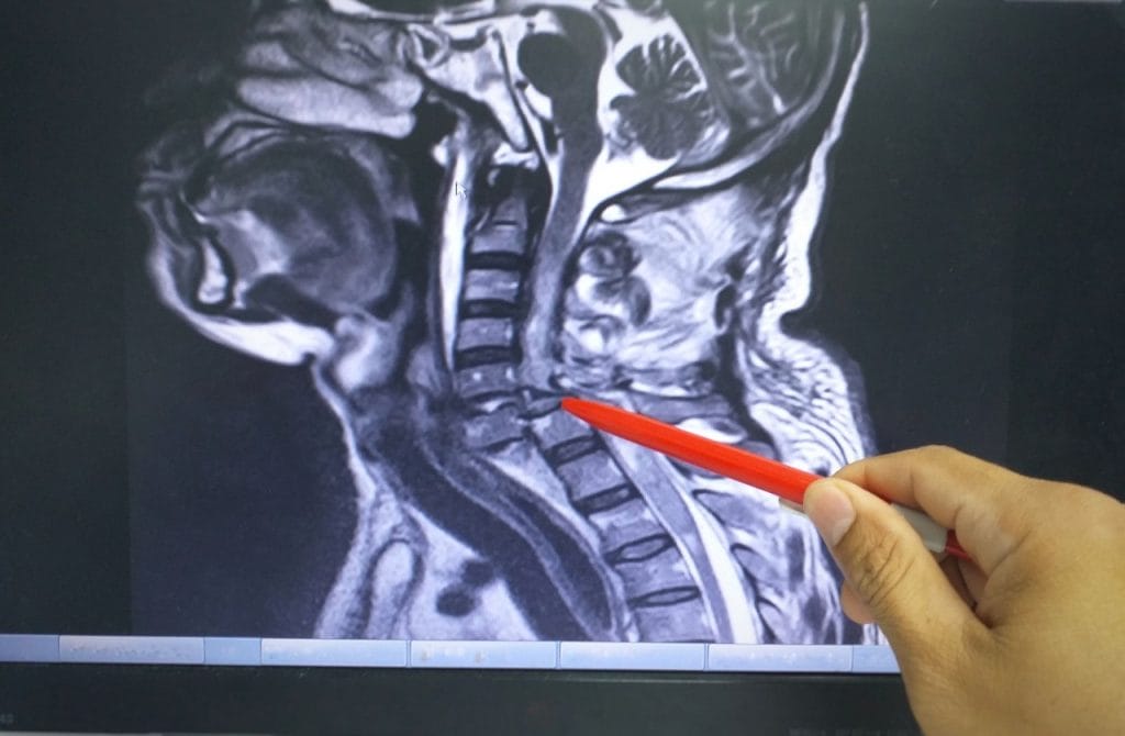 What are the Symptoms & Cause of Cervical Spine Injury?