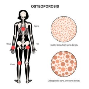 Osteoporosis & Spine Fractures in Women: Risks, Symptoms, Treatments