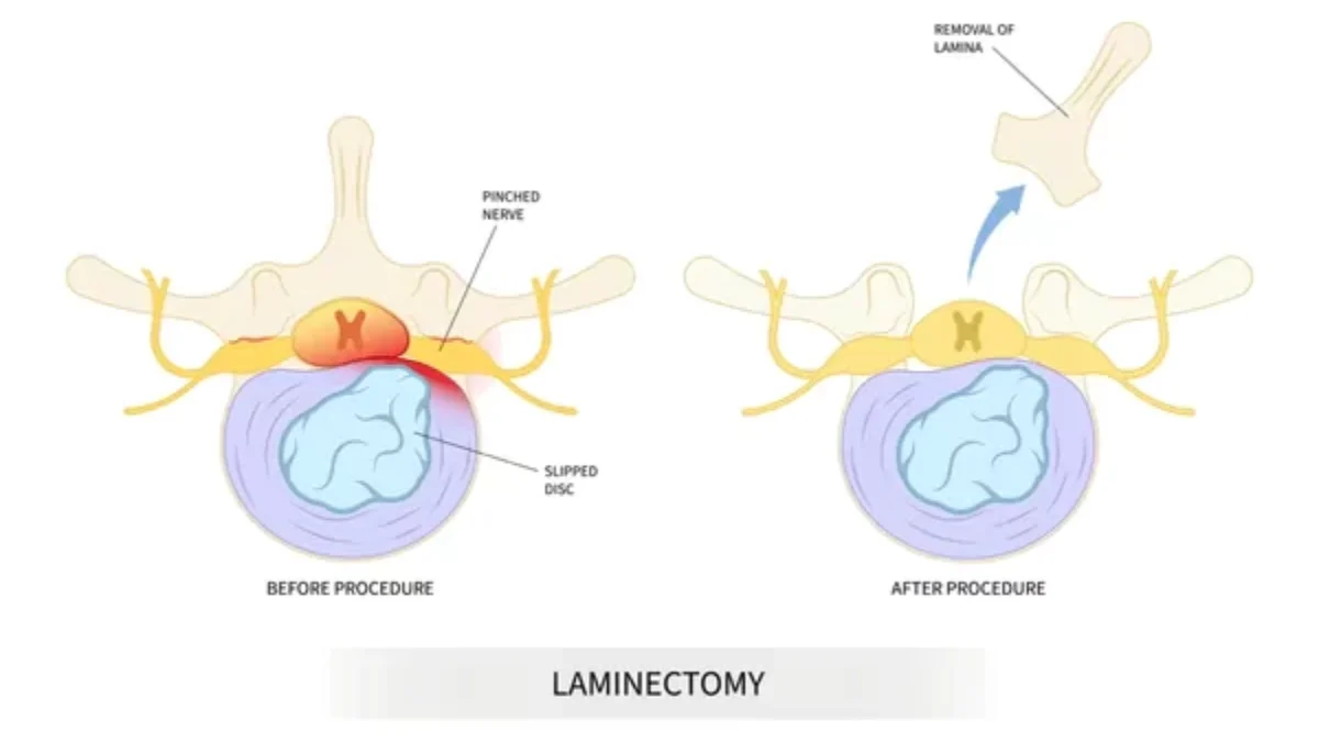 Laminectomy Surgery